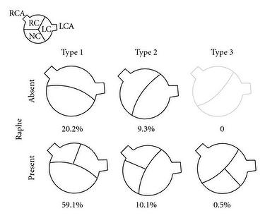 Bicuspid Aortic Valve Types Unicuspid Aortic Valve Repair Using