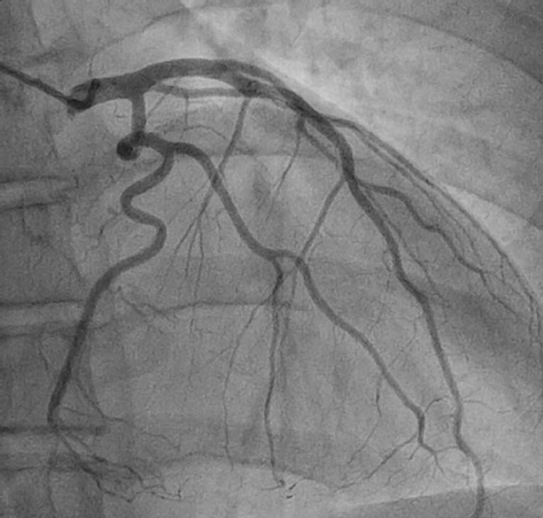 Spontaneous coronary artery dissection
