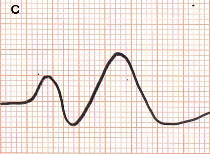 Second in a series on hyperkalemia: What are the clinical consequences ...