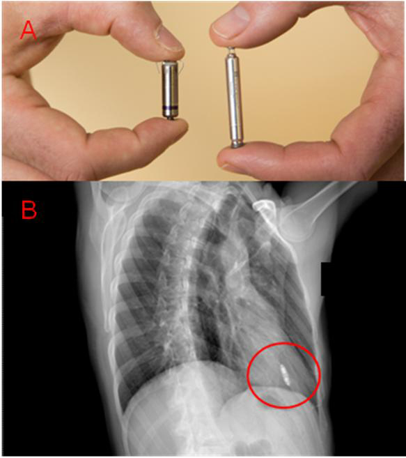 Second in a series on leadless pacing: Leadless cardiac pacemakers ...