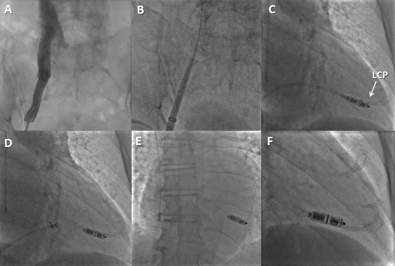 Second in a series on leadless pacing: Leadless cardiac pacemakers ...