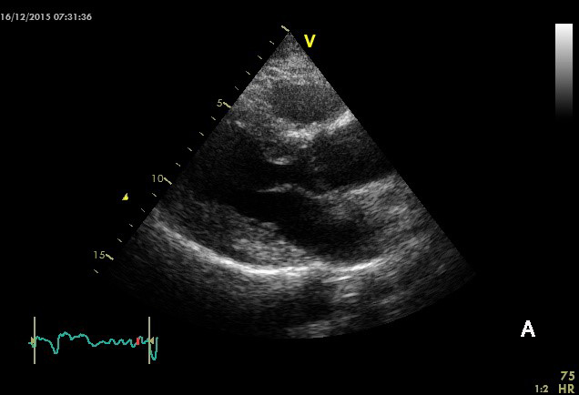 Third in a series on Fabry Disease: What is the importance of imaging ...