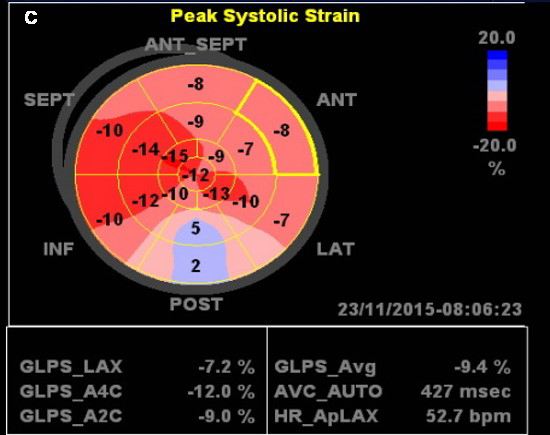 Third in a series on Fabry Disease: What is the importance of imaging ...
