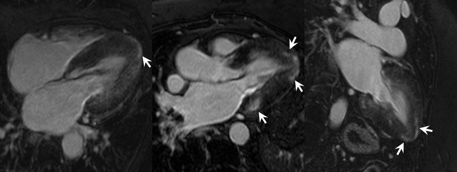 Third in a series on Fabry Disease: What is the importance of imaging ...