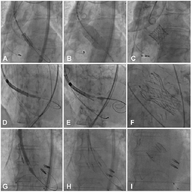 Technical aspects of transcatheter aortic valve implantation (TAVI)