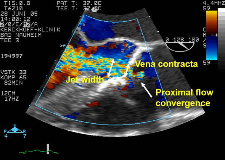 Chronic aortic regurgitation: diagnosis and therapy in the modern era