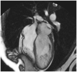 Cardiac Mri Lv Function :: Keweenaw Bay Indian Community