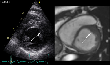 MRI in the diagnosis of hypertrophic cardiomyopathy