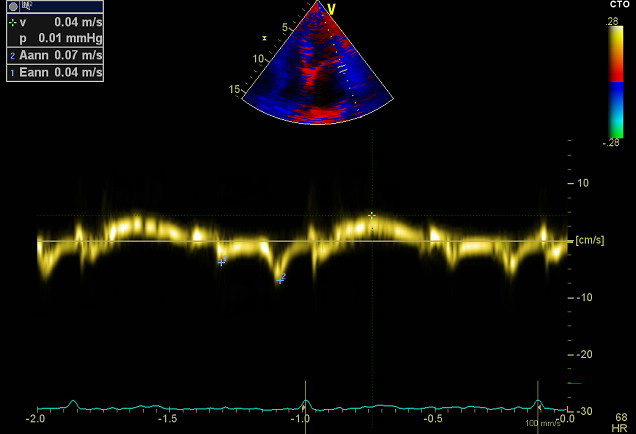 Low Gradient As With Normal Lv Function | IUCN Water
