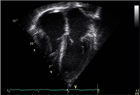 Icd 10 Evaluate Lv Function | semashow.com